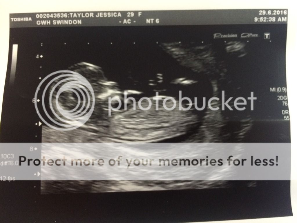 13 week scan - nub theory GIRL or BOY? | BabyCentre