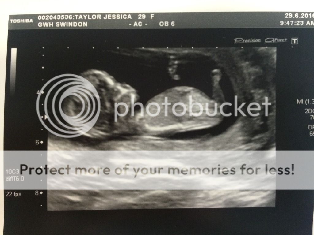 13 week scan - nub theory GIRL or BOY? | BabyCentre
